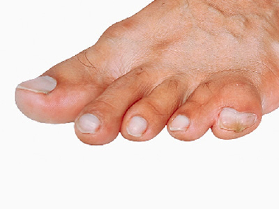 Causes and Treatment of Webbed Toes